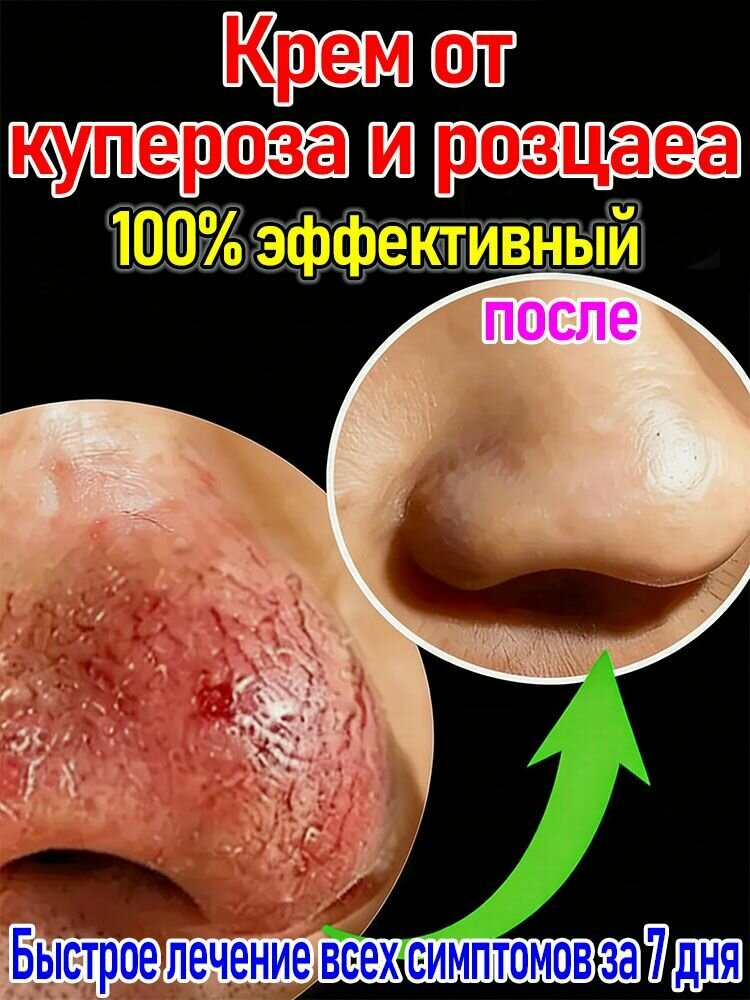 Крем для лица от купероза, розацеа, покраснений . для проблемной кожи,100% натуральный В безгормональном составе.50 мл