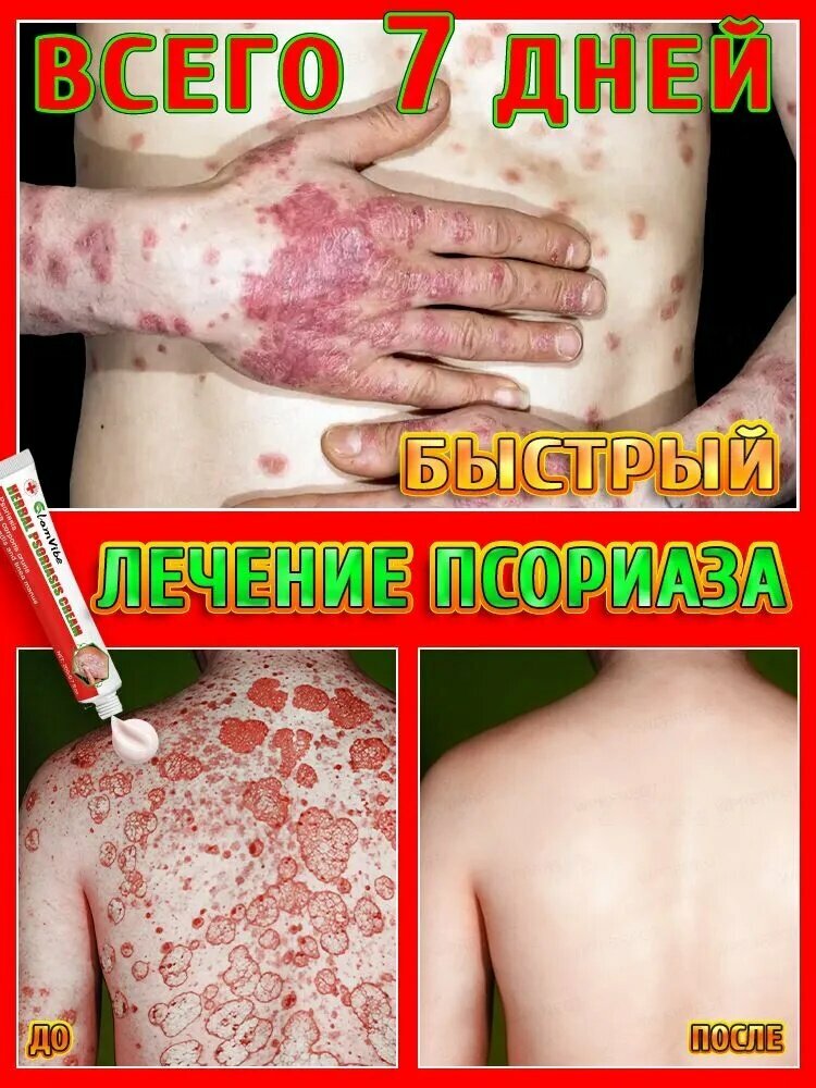 Мазь для лечения псориаза, экземы, дерматита, лишая, угревой сыпи, прыщей, способна быстро снять раздражение и покраснение кожи,20г