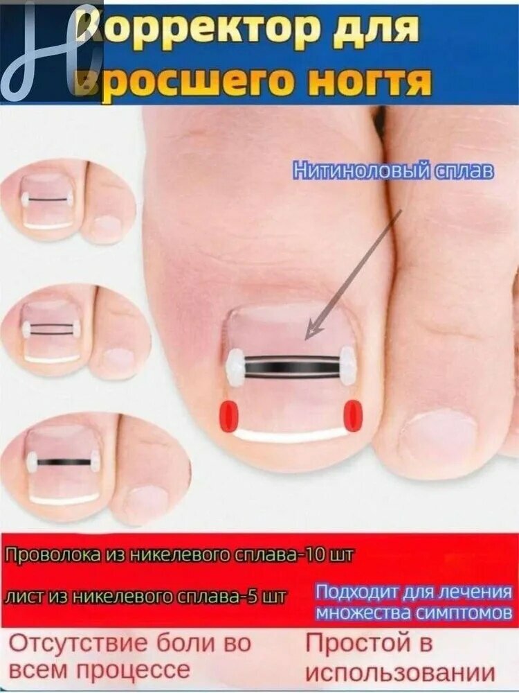 Эксклюзивный набор 15 никелидтитановых пластин для коррекции вросшего ногтя
