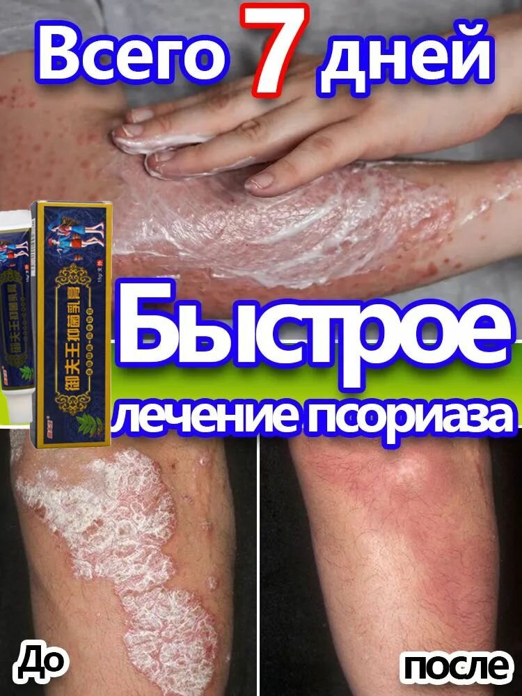 Универсальный крем-гель из Китая для ухода при симптомах псориаза, геморроя, прыщей и герпеса 15 г