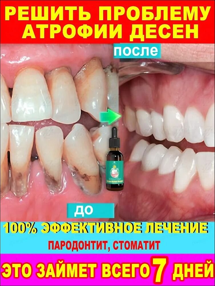 Устраняет кровоточивость десен, предотвращает атрофию, уменьшает разрывы, Наносите на зубы и десны для комплексного ухода за полостью рта, 30 мл