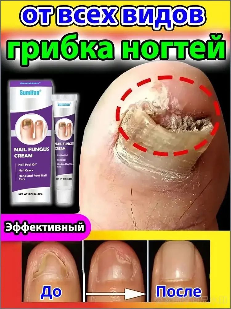 Эффективное средство от грибка ногтей на ногах, противогрибковая крем-гель для ног, уход за ногтями и кутикулой 20г