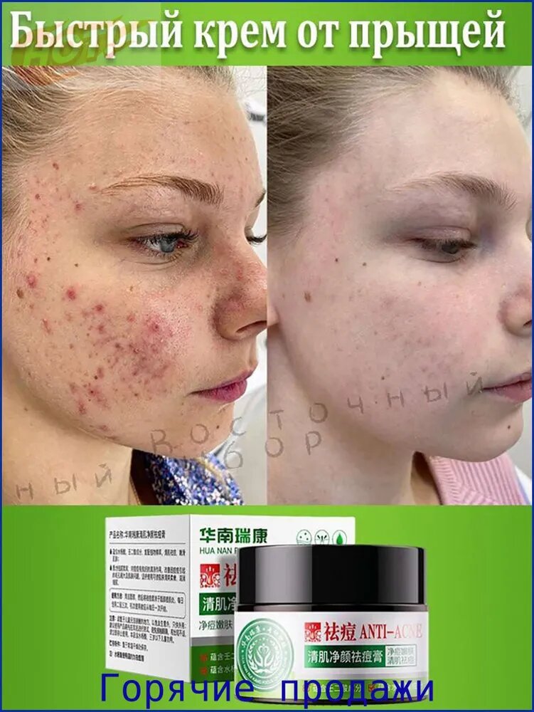 Крем для ухода за кожей от прыщей анти-акне, 30 мл