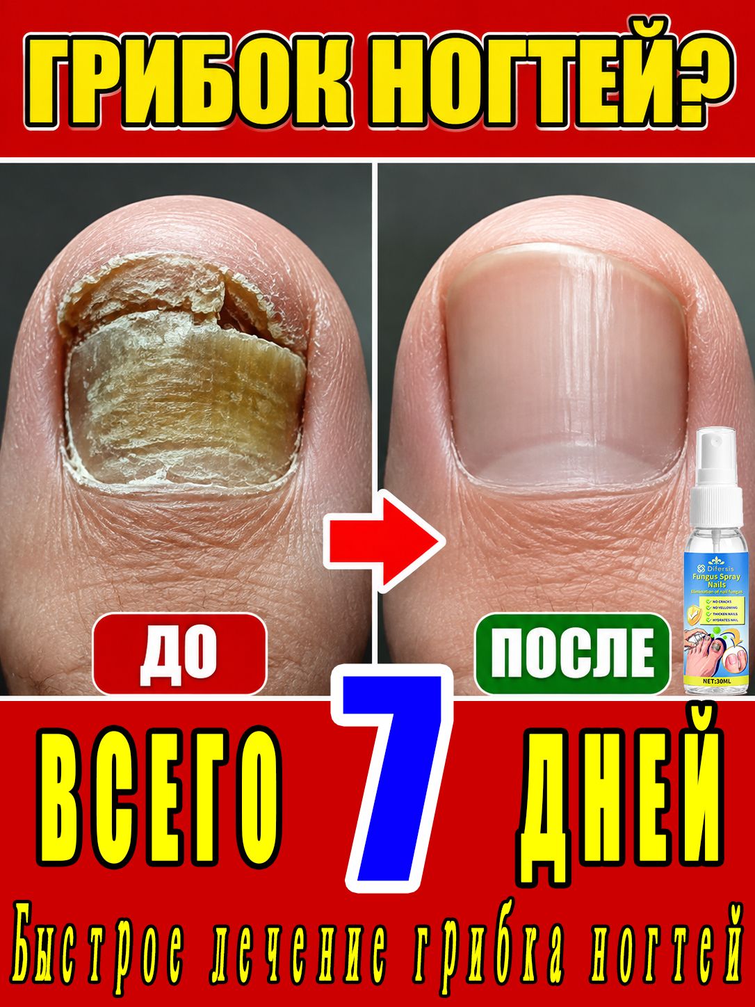 Средство от грибка ногтей и онихолизиса 30 мл