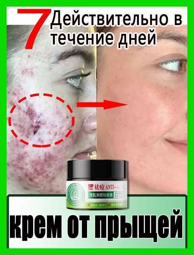 Крем для лица от прыщей и постакне, быстрое заживление, сужение пор и контроль масла, 30 г, для подростков и взрослых