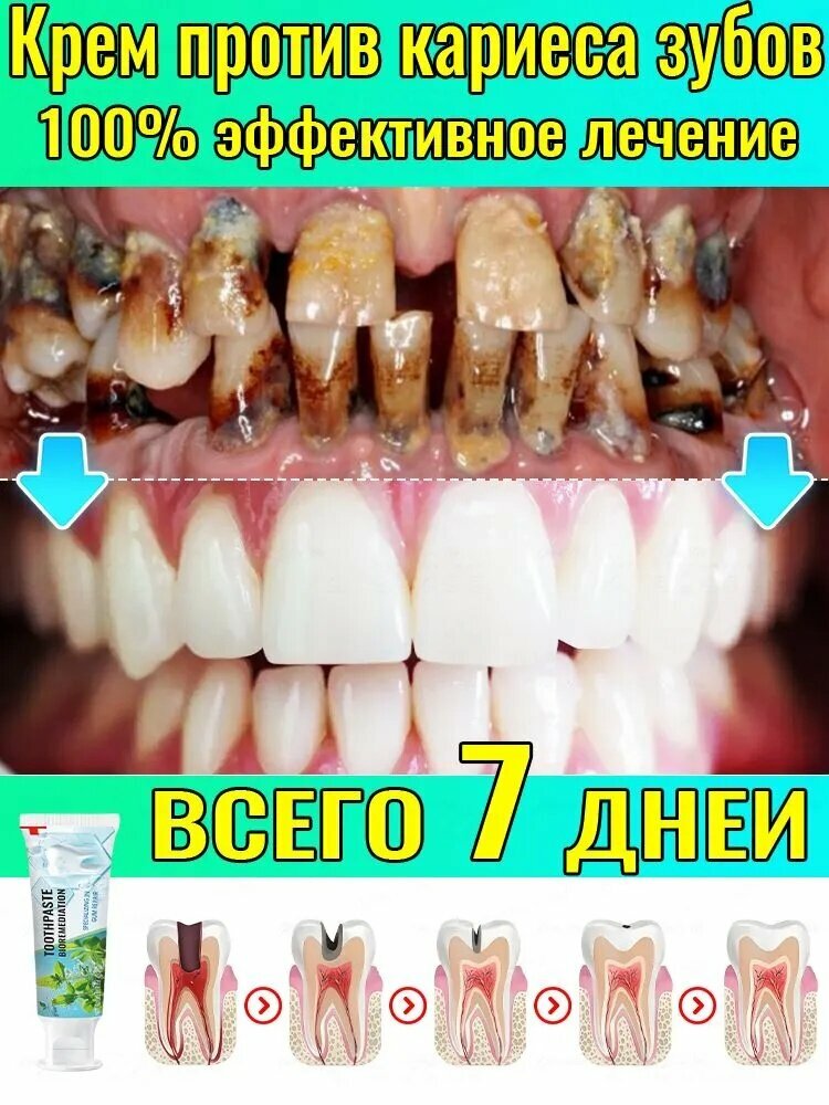 Зубная паста для отбеливания, используется для быстрого отбеливания зубов, полного удаления зубного налета, Профилактика кариеса и повышенной чувствительности зубов, 1 бутылка