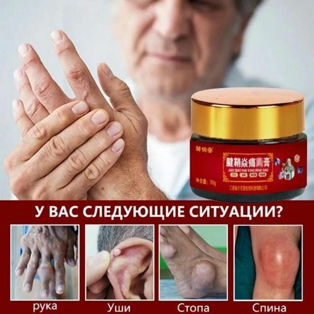 Мазь при вальгусной деформации стоп, подагре и шишках