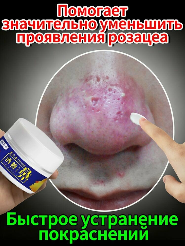 Мазь от розацеа на лице купероза и покраснений, Средство от розацеа, Китайская чудо-мазь для лечения розацеа,30 г