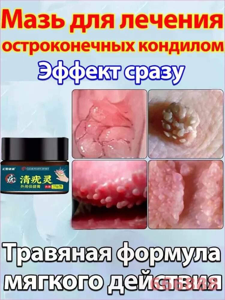 Эффективный крем от остроконечных кондилом для лечения проявлений ВПЧ. Удаляет кондиломы и папилломы в интимных зонах у мужчин и женщин. Результат проверен