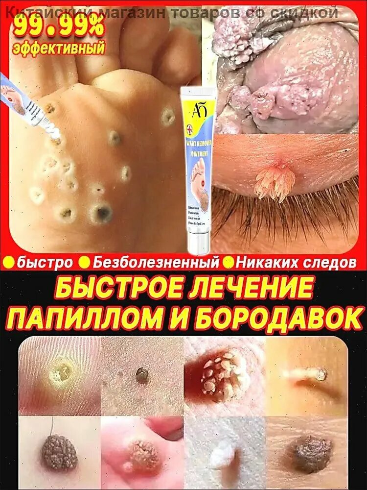 Гель-средство от папиллом, лечение бородавок, удаление родинок, крем от угревой сыпи, безболезненный, не оставляет следов, кожа становится гладкой и увлажненной, 3 шт