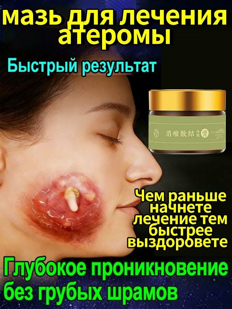 Мазь от атеромы, фурункулов, чирьев, гнойных прыщей противовоспалительное, антибактериальное, натуральное средство
