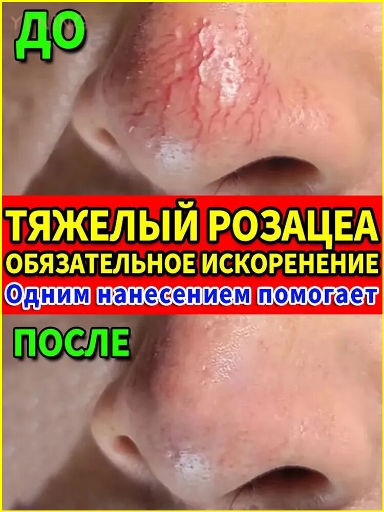 Крем от розацеа уменьшает покраснение и заложенность носа при розацеа и красном лице.20 г
