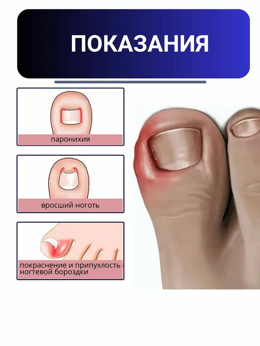 Средство от вросшего ногтя