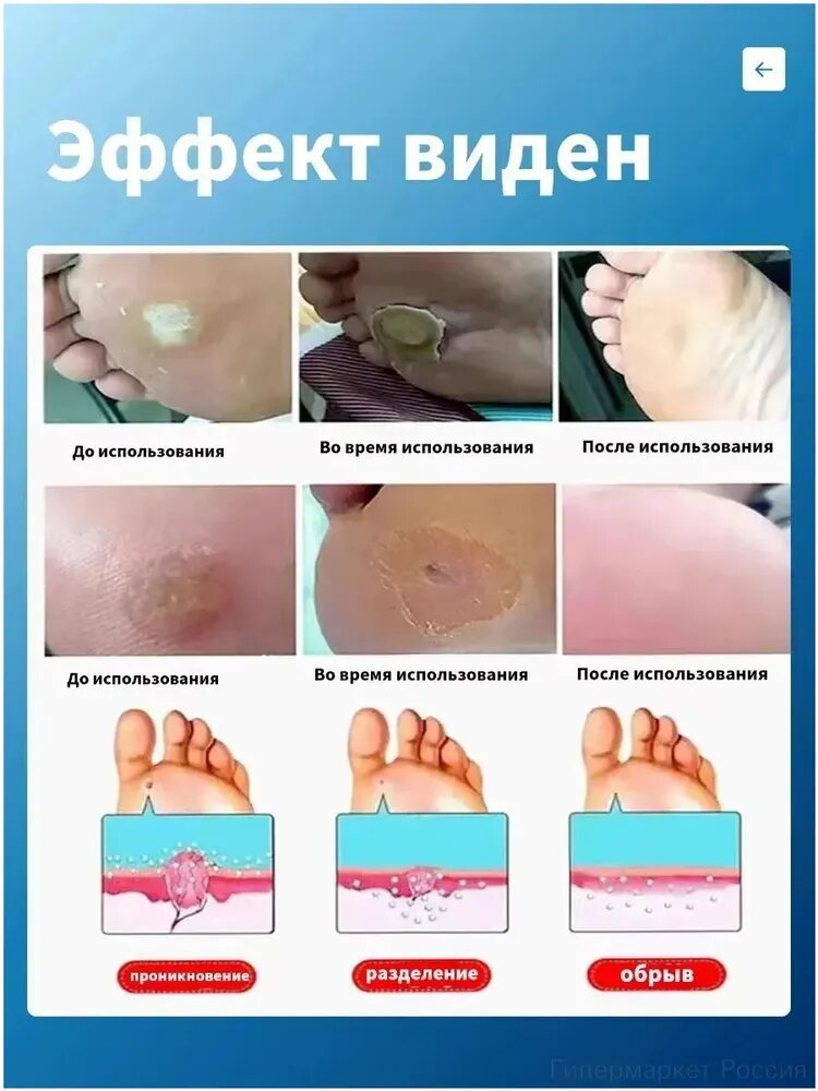 Mазь от мозолей стержневых и натоптышей , Крем от сухих мозолей, шипицы, бородавок, натоптышей,20 г