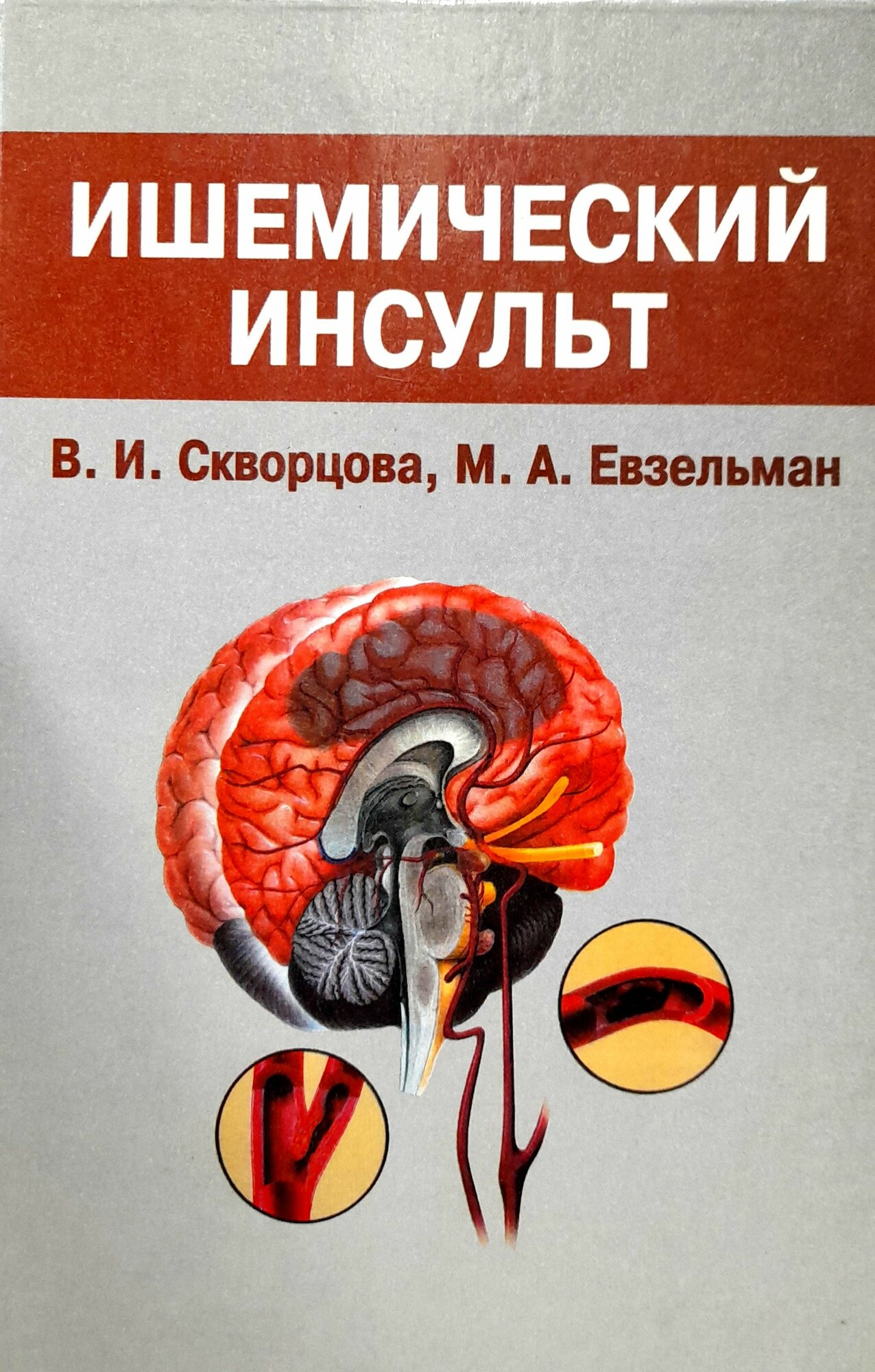 Ишемический инсульт. Скворцова