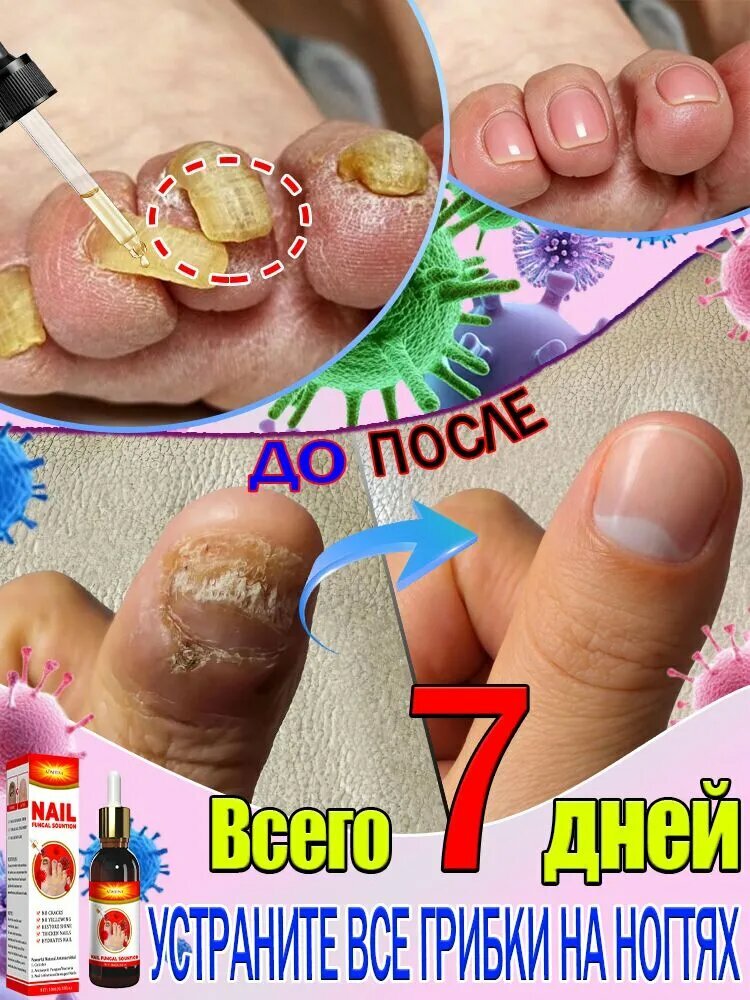 Эфирные масла, используемые для лечения грибковых инфекций. При пожелтении, утолщении и ломкости ногтей. Улучшают состояние потрескавшихся ногтей на ногах, уменьшают зуд и неприятный запах.10 мл