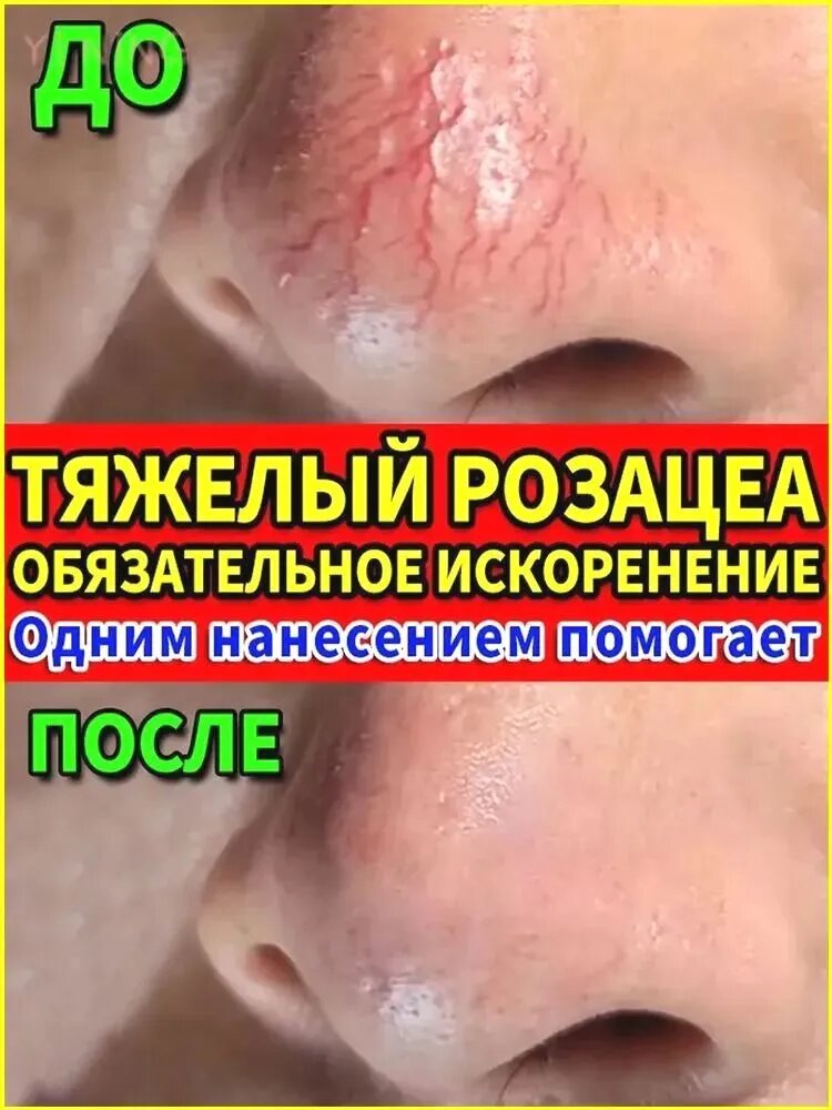 Крем от розацеа уменьшает покраснение и заложенность носа при розацеа и красном лице.20 г