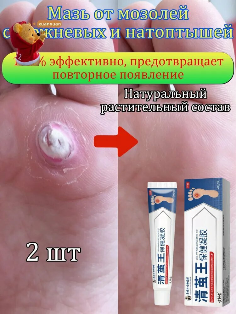 Пластырь от мозолей, бородавок и натоптышей лечебный, быстрое смягчение, безболезненное удаление,20 г.2шт