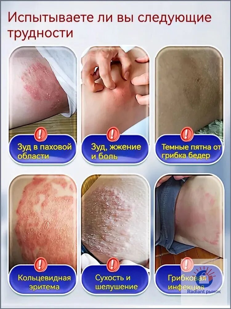 Паховый грибок противогрибковая мазь для кожи