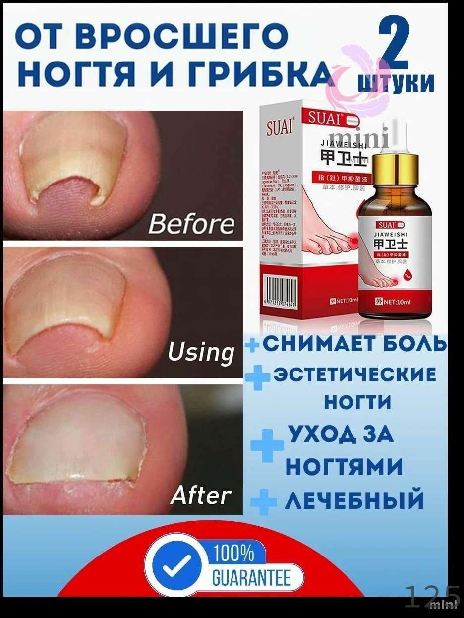 Вросшие ногти на ногах, удаляется масло паронихии, для ухода за ногтями на ногах11