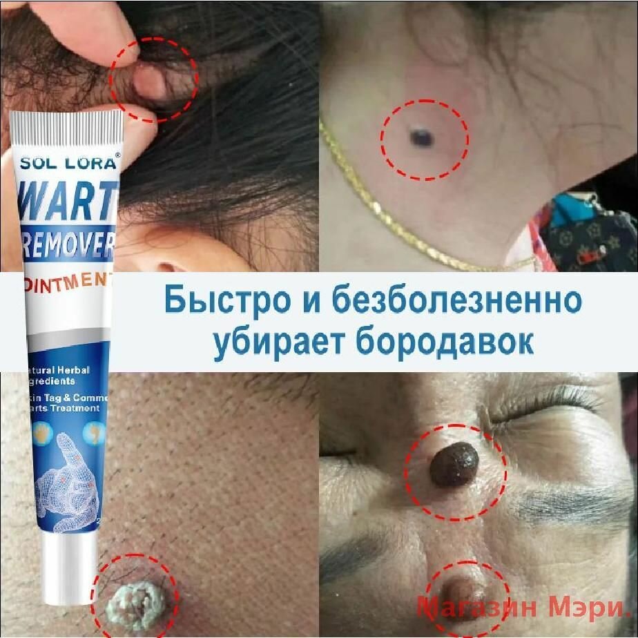 Крем от папиллом и бородавок/Средство для удаления бородавок, папиллом и родинок, от папиллом и бородавок на проблемной коже лица, рук и ног, мазь с чистотелом, 20 г