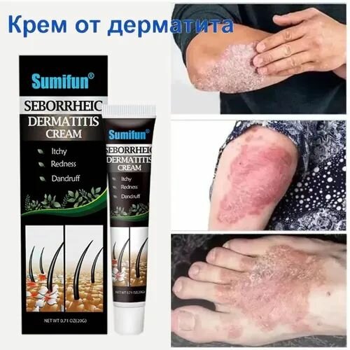 Крем от дерматита, для лечения себорейного дерматита, псориаза, зуда кожи, для кожи головы, тела и лица, 20 г