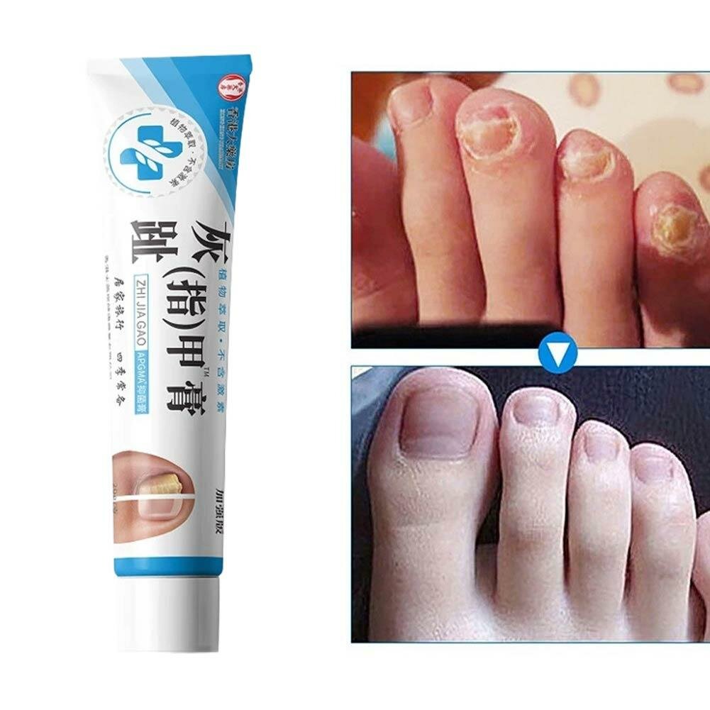 Крем от грибка ногтей, крем для восстановления ногтей на ногах