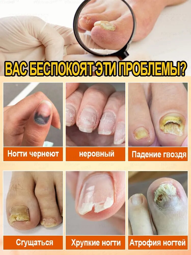 Спрей для ног и обуви от грибка. Уничтожает грибок стопы и ногтей. Дезинфекция обуви, профилактика рецидива. Быстрый результат.1 бутылка