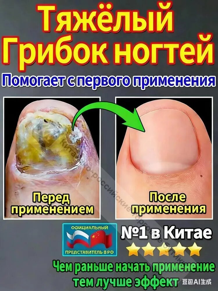 Мазь ноготок от грибка ногтей на ногах, Лечите грибковые инфекции, укрепляйте и восстанавливайте ногти и рого