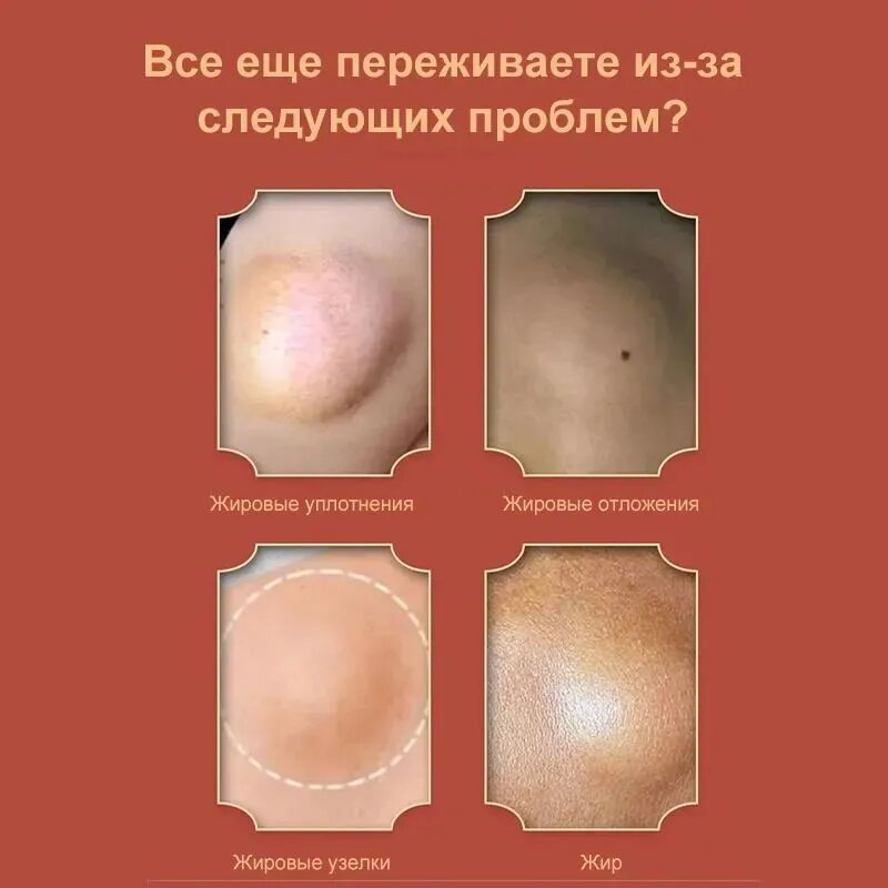 Мазь от липом и жировиков, быстро удаляет подкожные жировые опухоли, натуральный китайский, травяной крем для удаления целлюлита устранения, 30 г