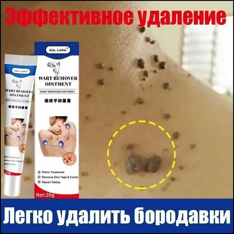 Мазь от бородавок, против генитальных бородавок, папиллом, ороговевшей кожи, мазь от прыщей, 20 гПечатная версия