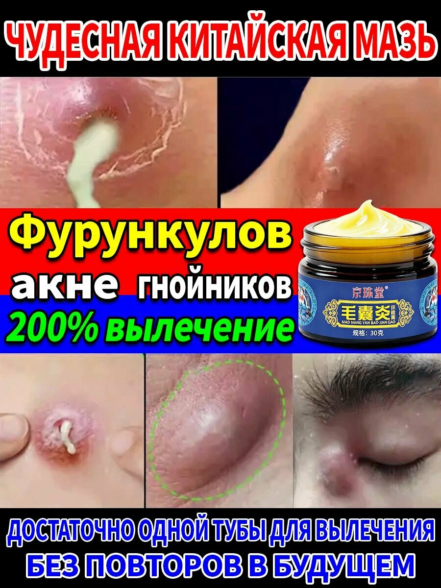 Вытягивающая мазь от фурункулов, чирей, акне и гнойников как Вишневского 30г, Китайская чудо мазь. Быстрый эффект.