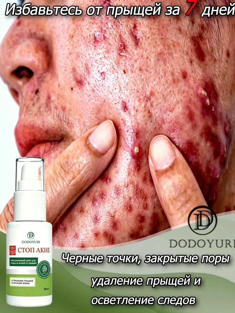 Крем от прыщей для подростков, уменьшает прыщи, комедоны и чёрные точки, осветляет следы постакне, с салициловой кислотой, контролирует жирность, 30 мл