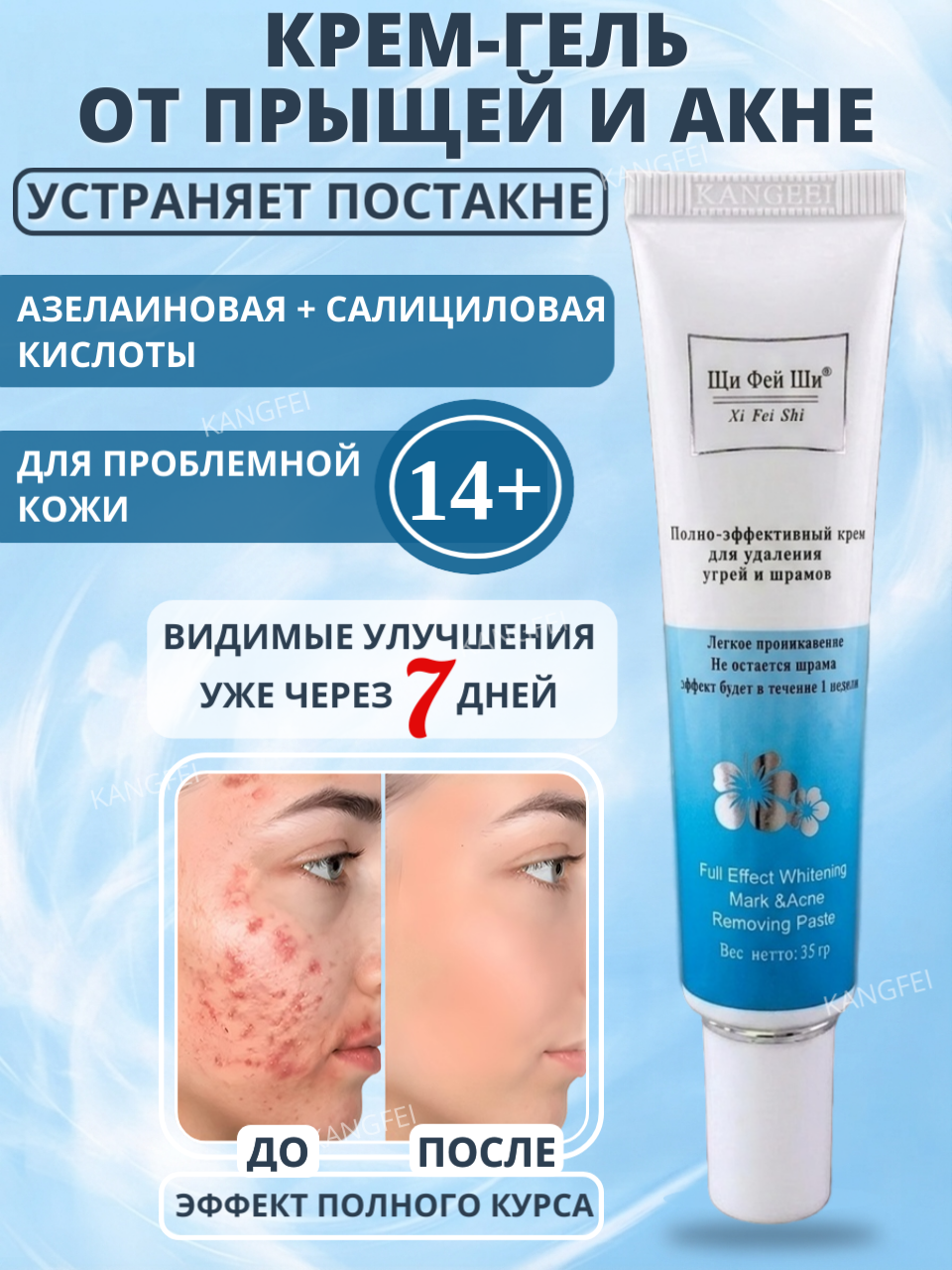 Крем - гель для проблемной кожи от прыщей, акне и постакне, мазь от угревой сыпи и комедонов на лице и теле, 35 мл.