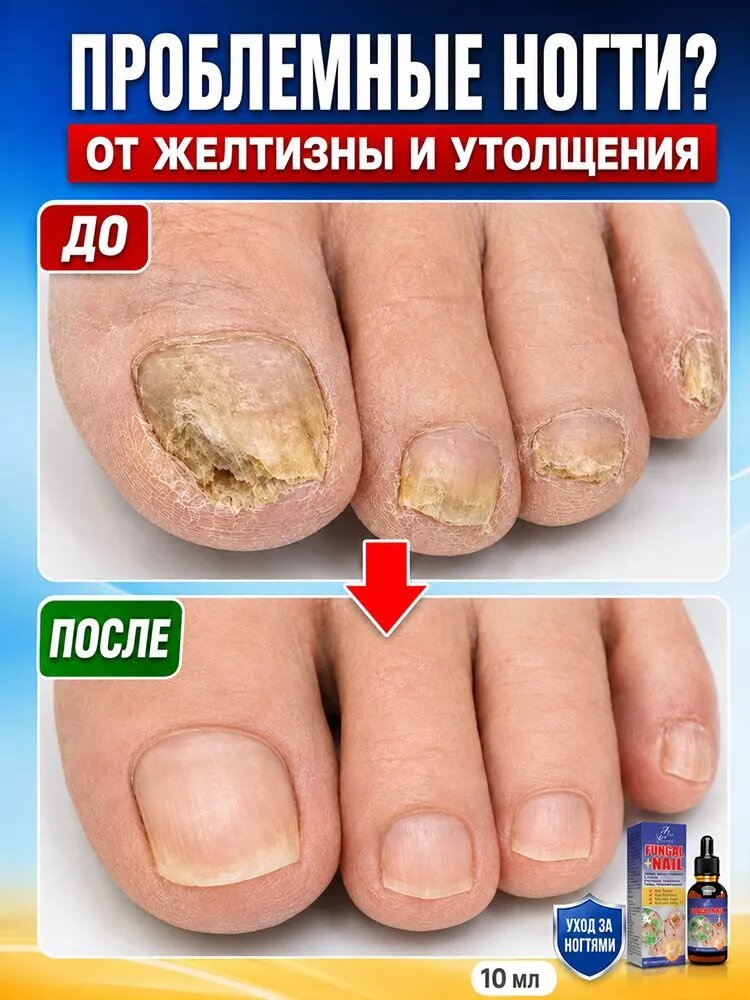 Масло от грибка ногтей и онихомикоза, при зуде, запахе, желтизне, утолщении, ломкости и трещинах, для восстановления, профилактики и укрепления ногтевой пластины, уход для рук и ног, 10 мл