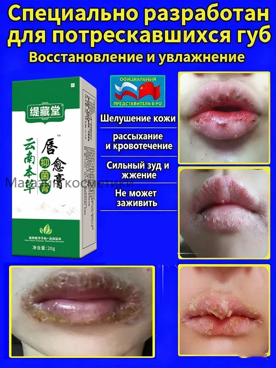 Антивирусная увлажняющая помада от герпеса, зуда, покраснений и волдырей губы против герпеса лечение зуда