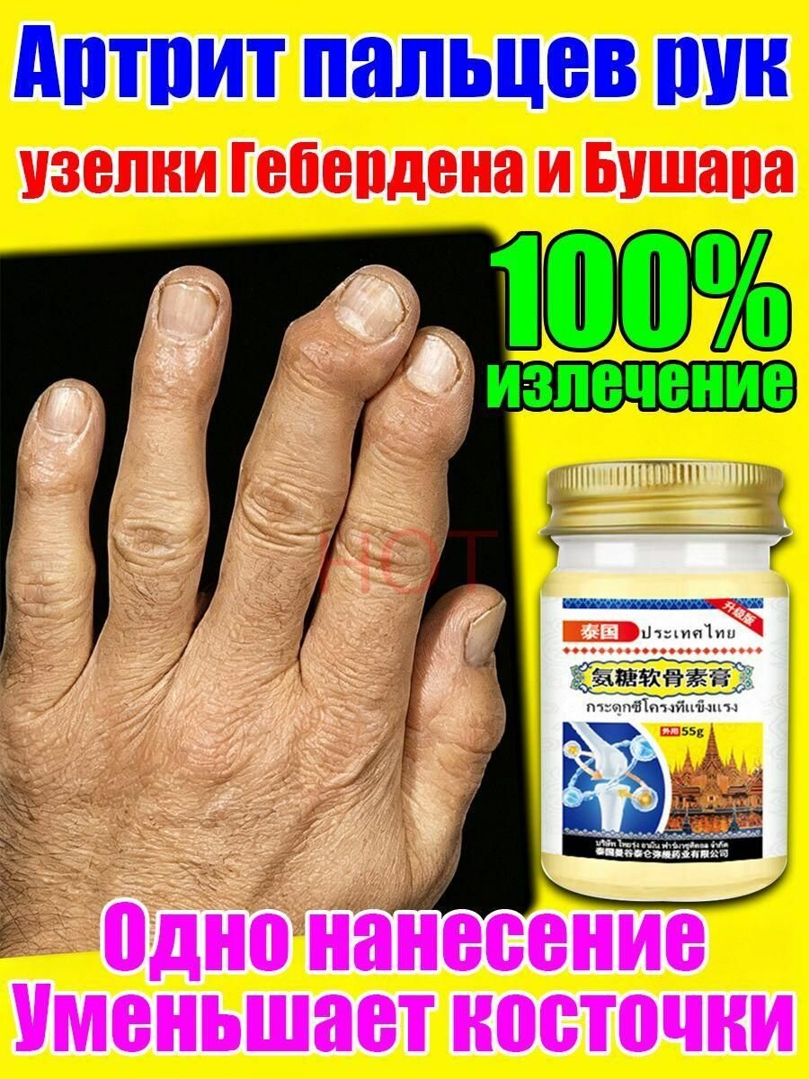 Мазь от артроза суставов пальцев рук и узелков Гебердена и Бушара