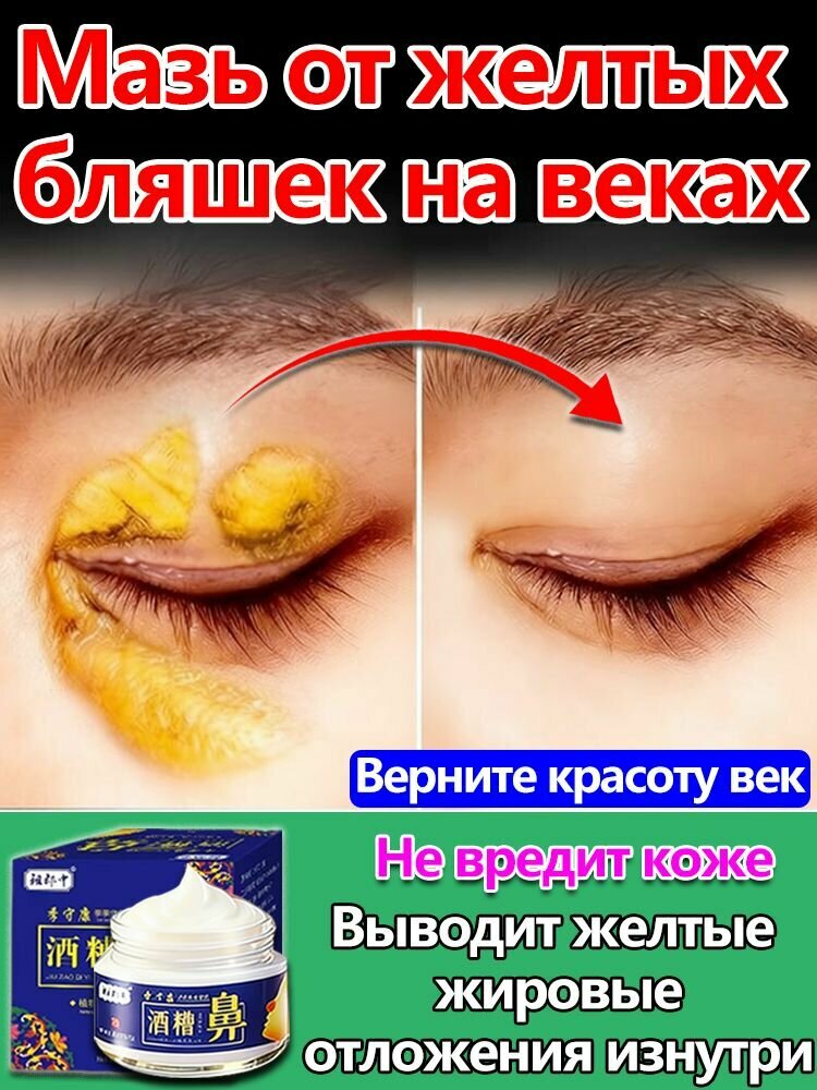 Мазь от ксантелазмы и ксантом на веках и лице. Лечение папул и желтых бляшек вокруг глаз. Эффективное средство против атеромы