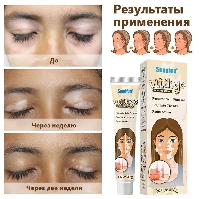 Sumifun Vitiligo Крем для ухода за кожей от пигментации кожи 20g