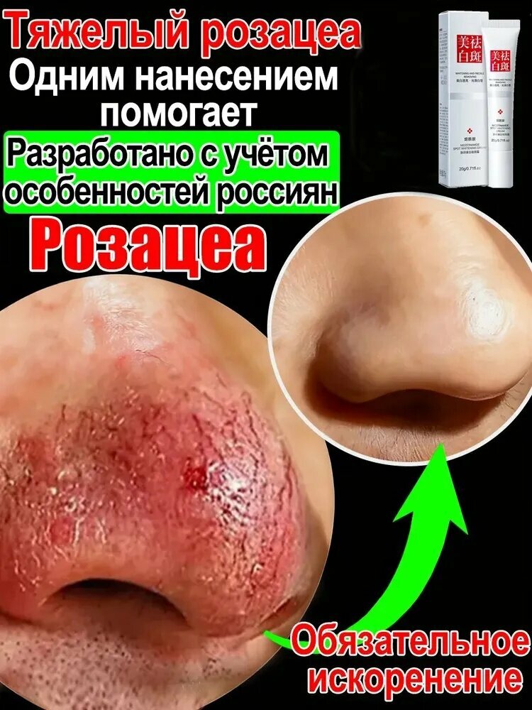 Крем от купероза для лица покраснений на лице и розацеа, Куперофаг Крем от купероза на лице, антикупероз, средство от сосудистых звездочек, от покраснений, розацеа, Китайская чудо-мазь.20 г