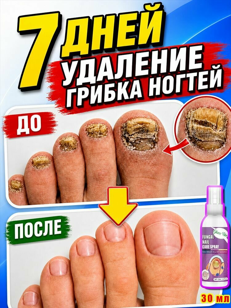 Спрей для лечения грибка ногтей, который устраняет грибки в течение 7 дней и непрерывно стерилизует в течение 24 часов для устранения онихомикоза, утолщения, зуда и неприятного запаха.30 мл против грибка ногтей 30мл средство от онихомикоза