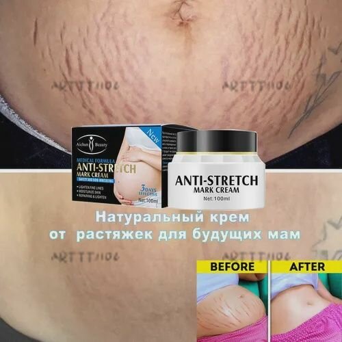 Крем от растяжек для беременных 100 грамм, используется при целлюлите и растяжках, подходит для ног и живота, восстанавливает и питает кожу. fRXxq