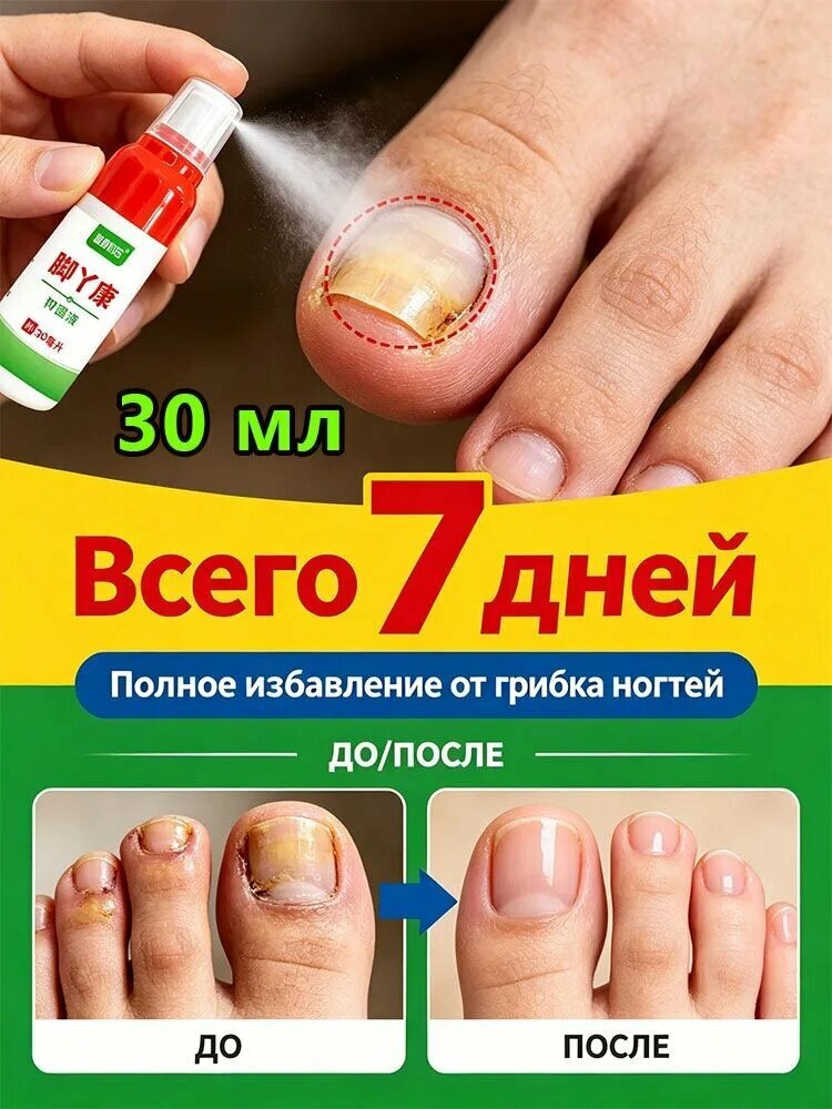 Спрей от грибка ногтей на ногах, для лечения плесневых инфекций, укрепления ногтей, удаления рогового слоя и устранения онихомикоза.30 мл