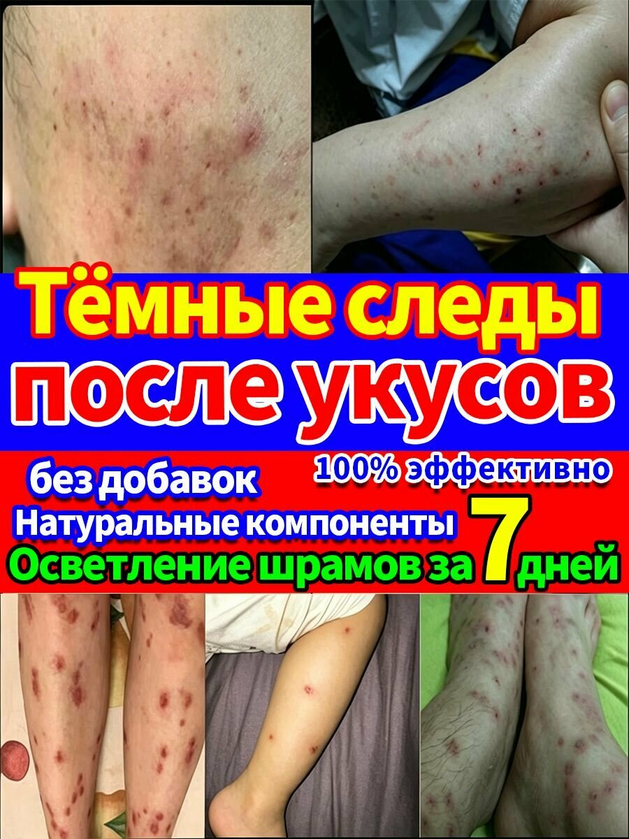 Мазь от пигментации и шрамов после укусов насекомых, 30 г