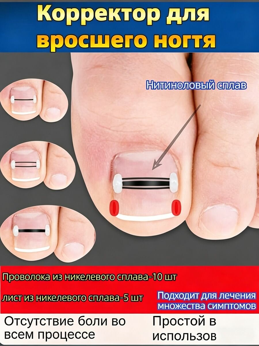 Комплект из 10+5 никелид-титановых корректоров для вросших ногтей 15 штук коррекция вросших ногтей