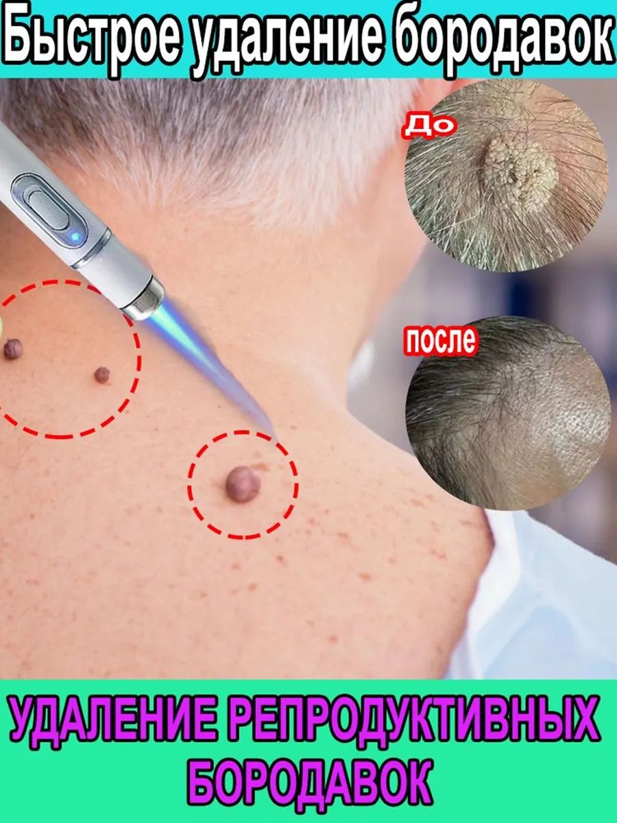 Лазерная указка для удаления бородавок. Безболезненное и без рубцов удаление бородавок и папиллом без вреда для здоровой кожи. упаковка - 1 штука. лазерная указка удаление бородавок безболезненное удаление папиллом