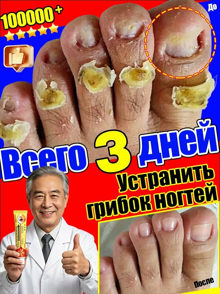 Мазь для ухода за ногтями при грибковой инфекции, восстановление ногтей, укрепление и защита ногтевой пластины, 30 г