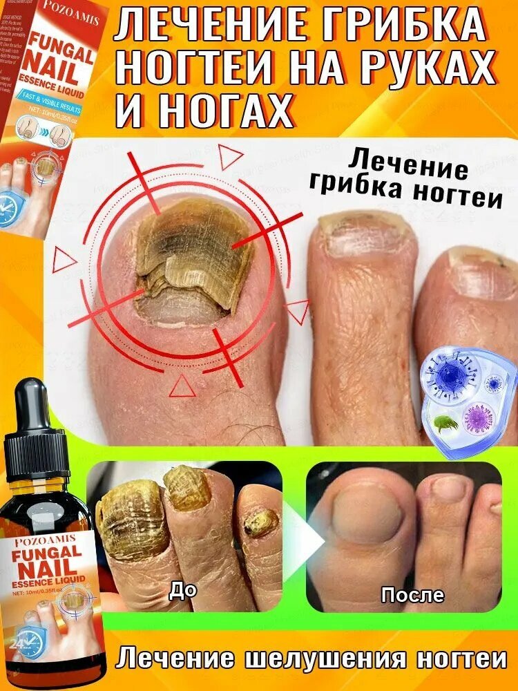 Средство от грибка ногтей на ногах эффективное/ Масло от онихомикоза. Противогрибковое , восстанавливает ногти. Попрощайтесь с онихомикозом!