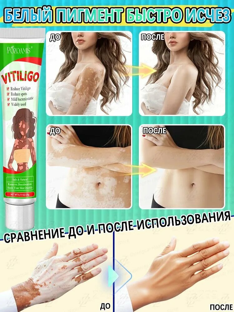 Мазь от витилиго, Средство при нежелательной пигментации витилиго.200 мл
