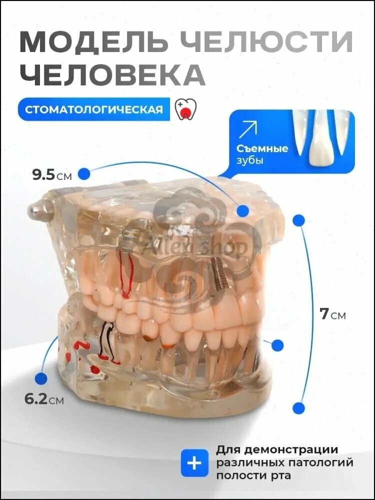 Стоматологическая модель челюсти с патологиями зубов анатомическая белый бежевый светло-розовый
